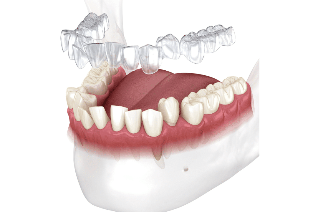 ARK Esthetics: Why Invisalign Works Faster for Certain Patients